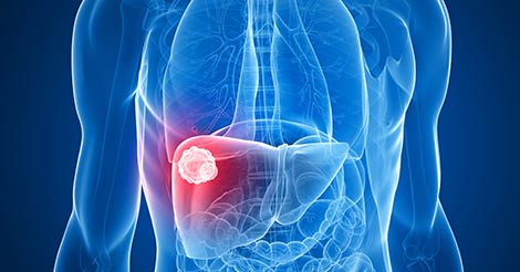 Liver Cancer Causes & Risk Factors | Symptoms & Awareness